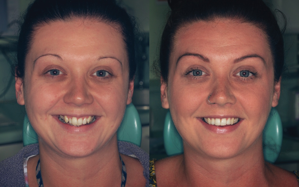 Incredible Adult Braces Before And After Comparisons